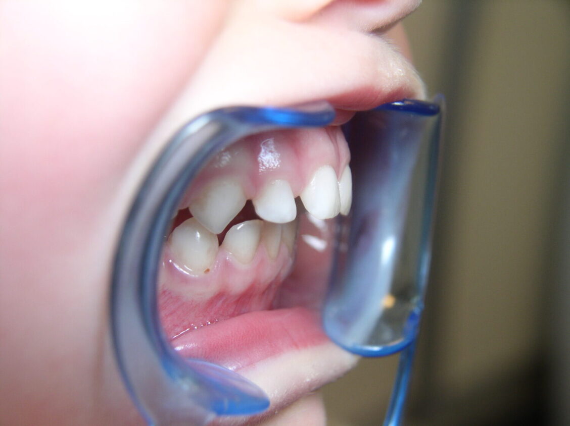 Wat is een overbeet? | Ortho Billet